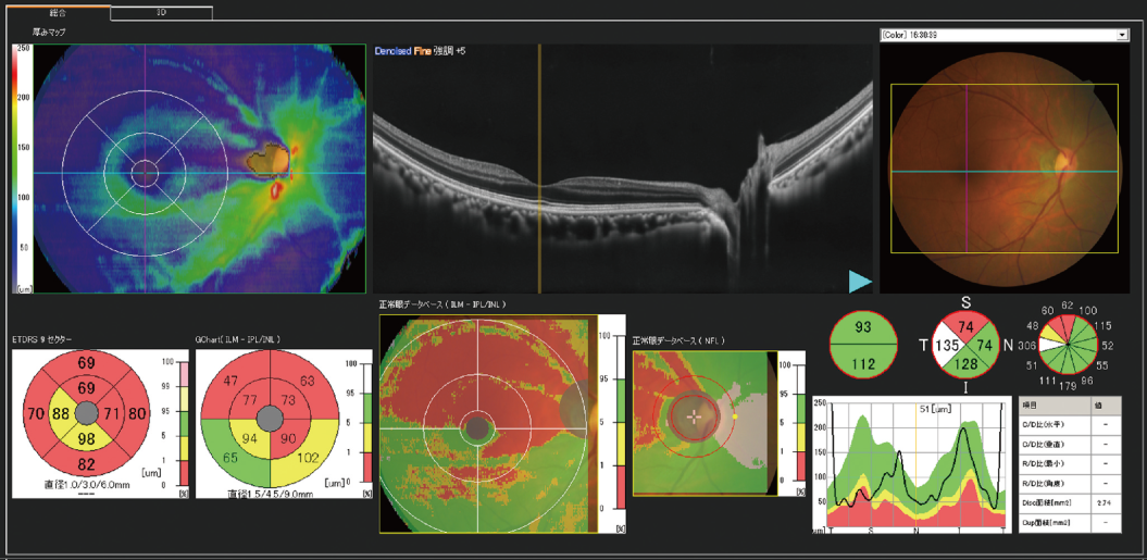 眼底カメラ付き光干渉断層計 Retina Scan Duo™2 | 光干渉断層計（OCT） | 株式会社ニデック